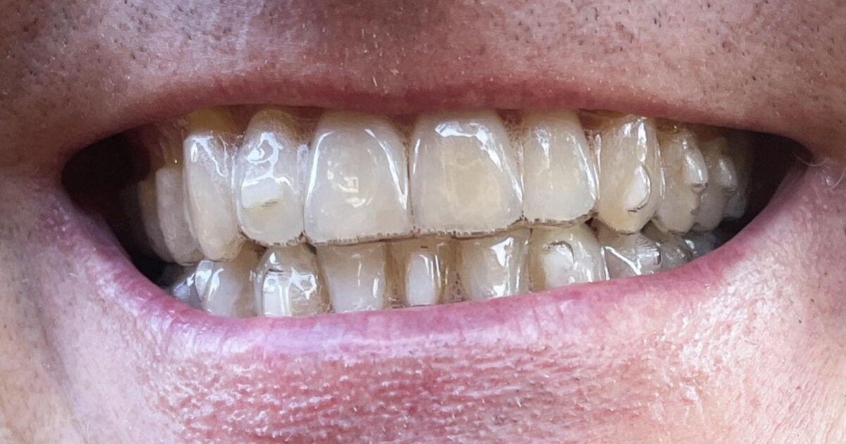 Australian Hiker | Hiking with Invisalign